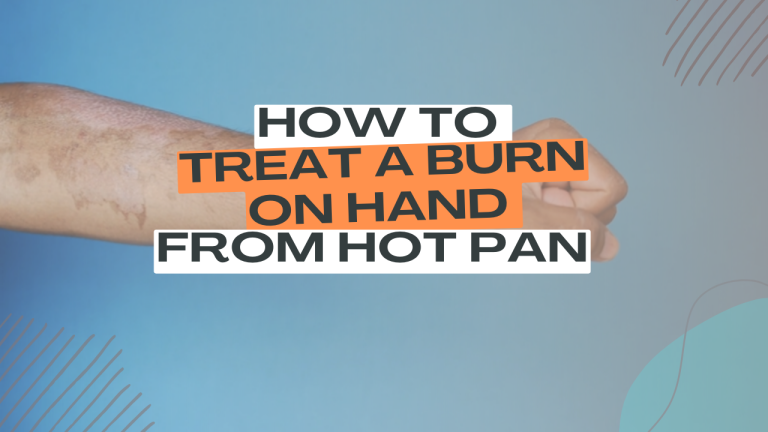 How to Treat a Burn on Hand From Hot Pan - Using Household Things